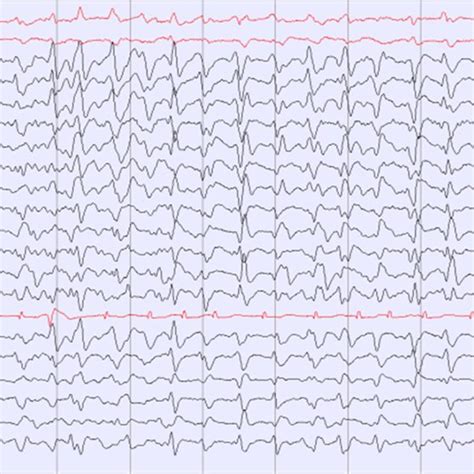Pdf Significance Of Triphasic Waves In Metabolic Encephalopathy
