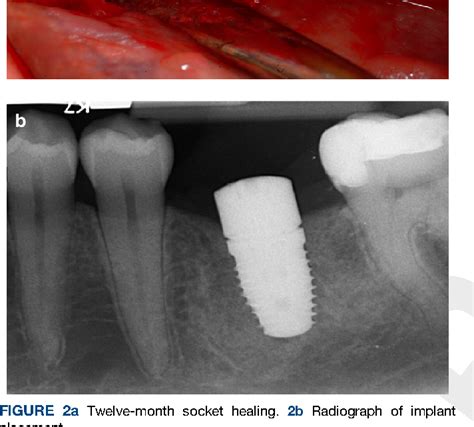 Figure 2 From The Use Of A Xenogeneic Collagen Matrix As An