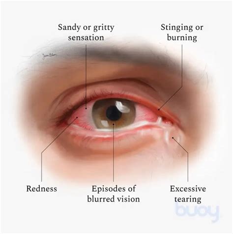 Dry Eye Syndrome Cypress Eye Centre