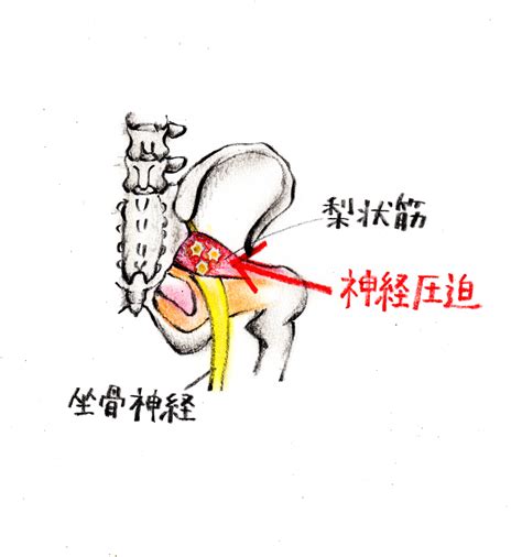 坐骨神経痛 トレシピ！