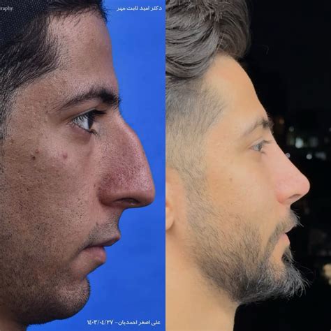‎دکتر امید ثابت مهر عمل بینی‎ Dromidsabetmehr • Instagram Photos