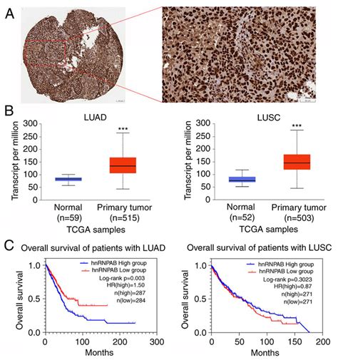 Hnrnpab Expression Is Upregulated In Nsclc Tissues And Correlates With