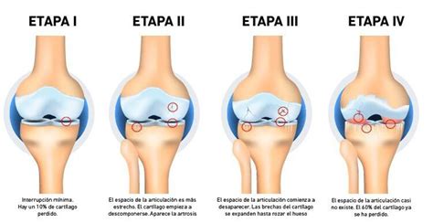 Artrosis De Rodilla Todo Sobre El Mal Que Padece Diego Maradona Muy
