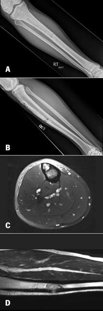 Bridging The Gap Solutions For Intercalary Long Bone Reconstruction