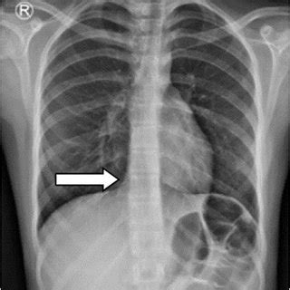 Chest X Ray Normal Cardiac Silhouette And Normal Pulmonary