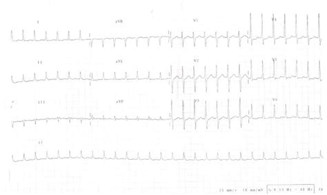 Ecg 1 The 12 Lead Electrocardiogram And Rhythm Strip Showing