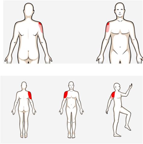 Week 2 Shoulder Joint Mobility And Soft Tissue Deficits Irritability