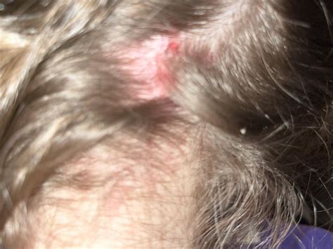 Stress Has Brought Back My Scalp Psoriasis Again R Psoriasis