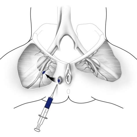 Sentinel Lymph Node Mapping Sentinel Lymph Nodes Are Localized By Download Scientific Diagram