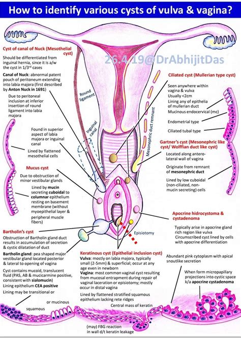 Inclusion Cysts On Labia