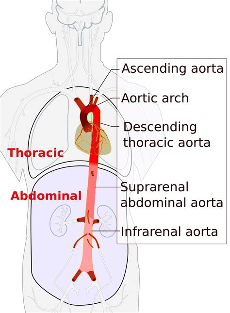 Aortic Dissection Explained Risk Factors Symptoms Diagnosis