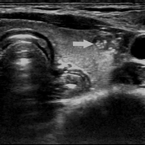 A Papillary Thyroid Carcinoma With Multiple Punctate Echogenic Foci
