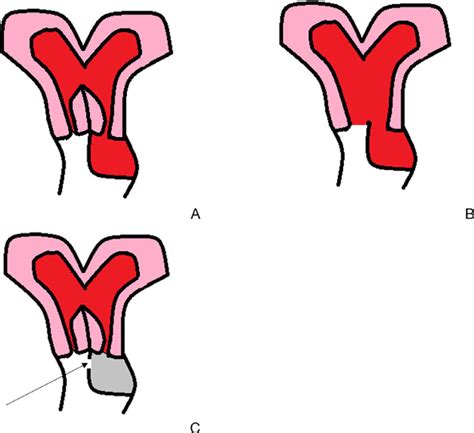 Reported Variants In Bicornuate Uterus A Bicornuate Uterus Bicollis