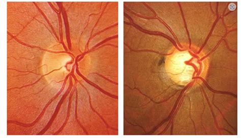 What Does A Glaucoma Diagnosis Mean Socal Eye