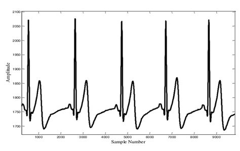 Ecg Signal Demodulated By The Proposed Chaotic Algorithm Snr 18 Db