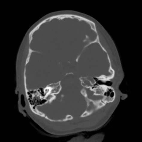 Cerebral Tuberculosis With Dural Sinus Invasion Radiopaedia 60353