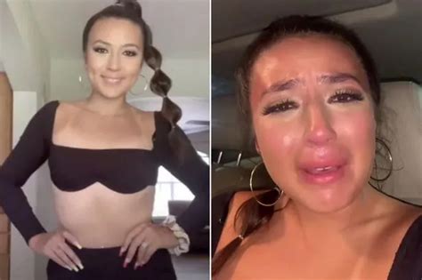 Women With Tree Trunk Legs Caused By Rare Condition May Receive Liposuction On NHS Daily Star