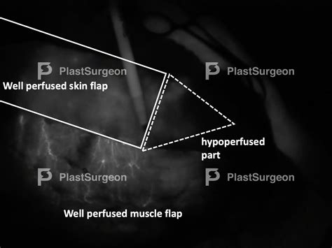 Case 4 Extensive Scalp Reconstruction Using A Free Myocutaneus Lattisimus Dorsi Flap Plastsurgeon