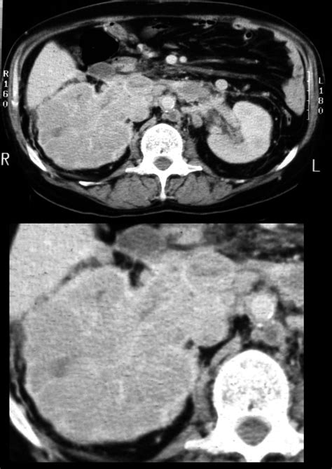 Delayed Finding The Common Vein