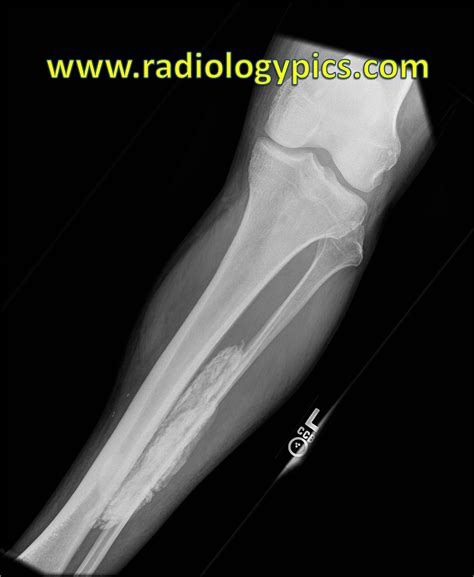Solution To Unknown Case 35 Calcific Myonecrosis Radiologypicscom
