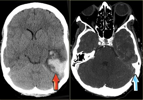 The Radiology Assistant Cerebral Venous Thrombosis