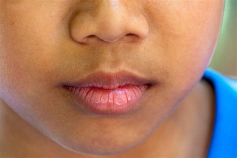 Black Spots On The Lips Causes Treatments And Prevention Tips