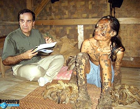 Unexplained Mysteries Tree Man Dede Cured Unexplained Mysteries