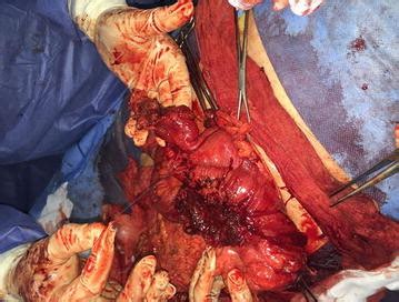 Perforated Appendix Download Scientific Diagram