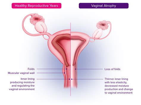 Vaginal Atrophy