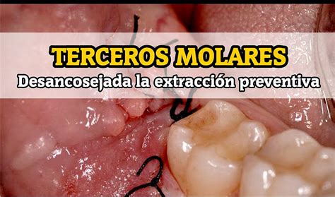 Muelas Del Juicio Desaconsejada La Extracción Preventiva Generalizada