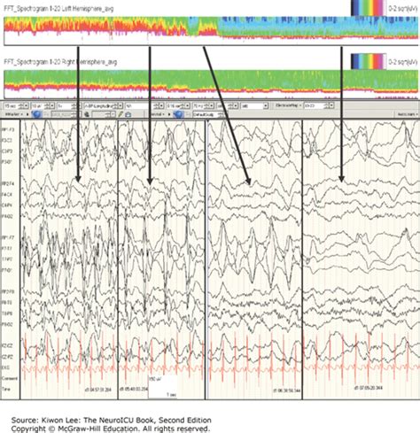 Continuous Electroencephalogram Monitoring In The Icu Neupsy Key