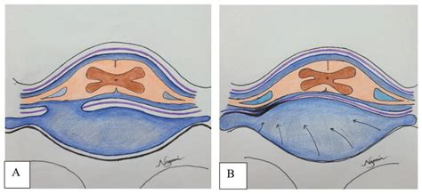 Schematic Picture Demonstrated An Extradural Arachnoid Pouch With A