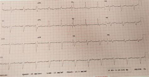 Bifascicular And Trifascicular Block Deranged Physiology