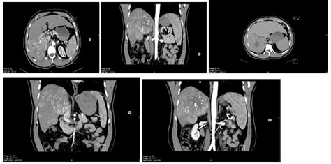 A Triphasic Abdominal Ct Showed Advanced Hcc Ct Liver Arterial Phase Download Scientific