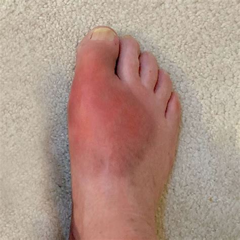 Primary Gout In A 6 Year Old Girl Presenting As A Foot Mass A Case Report