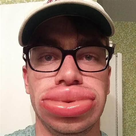 People Share Their Worst Bee Sting Lips Metro News