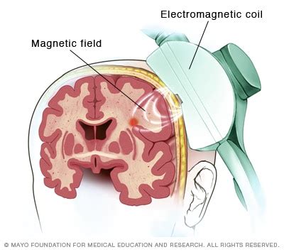 Transcranial Magnetic Stimulation Mayo Clinic