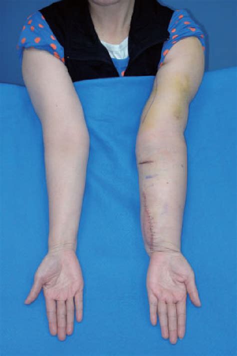 Epitrochlear Lymph Node Enlargement