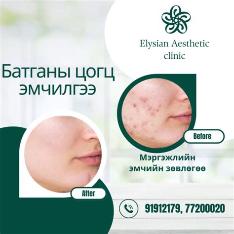 Elysian Батга яагаад ихэсдэг вэ ☝️Батга гарах хамгийн гол шалтгаануудын нэг бол хэт их тос