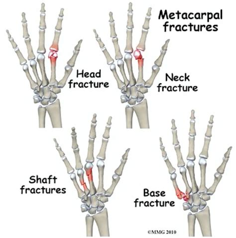Metacarpal Fractures — Maimonides Emergency Medicine Residency