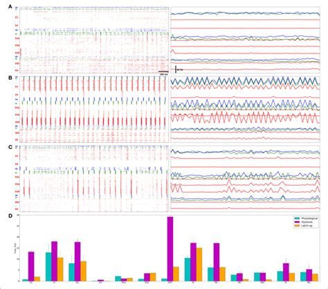 Distinct Firing Patterns In Physiological Dystonia And Epileptiform