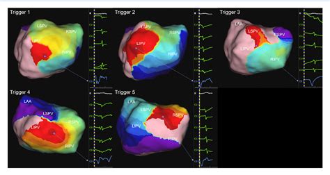 Figure 1 From Noncontact Charge Density Mappingguided Ablation Of