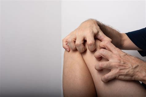 Psoriasis And Cellulitis Burden Has Increased In The Us According To