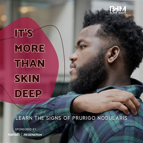 Prurigo Nodularis Pn Is A Rare Skin Disease Thats Often