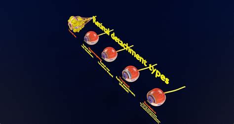 Retinal Detachment Types Eye 3d Model Superhive Formerly Blender Market
