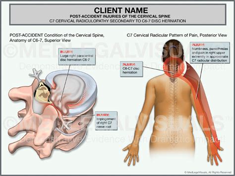 C5 6 Radiculopathy Treatment Cervical Radiculopathy Symptoms Causes