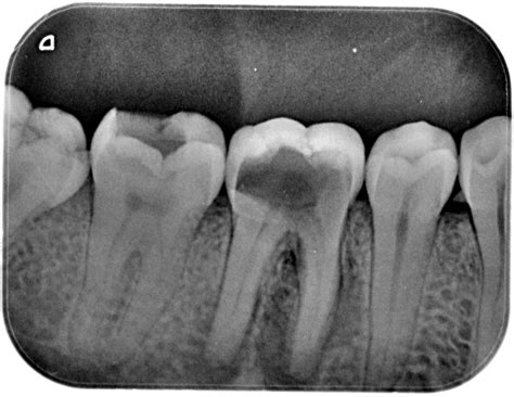 One For Testing Something Yolo Object Detection Model By Dent Dataset