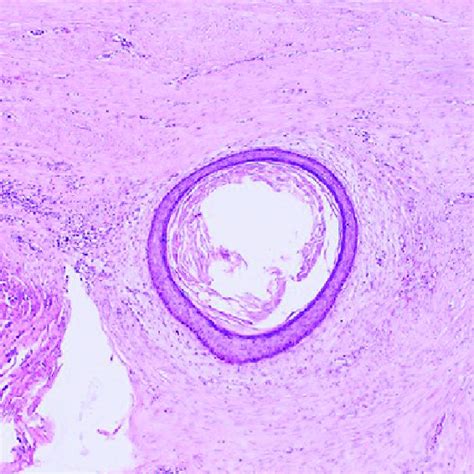 Figure2 Histopathological Finding Of The Subcutaneous Lesion Patient 3