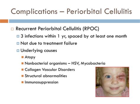 Ppt Periorbital Vs Orbital Cellulitis Powerpoint Presentation Free