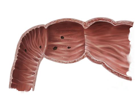 Duodenitis Photograph By Medical Graphics Michael Hoffmann Science